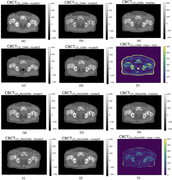 Feasibility of CycleGAN enhanced low dose CBCT imaging for prostate ...
