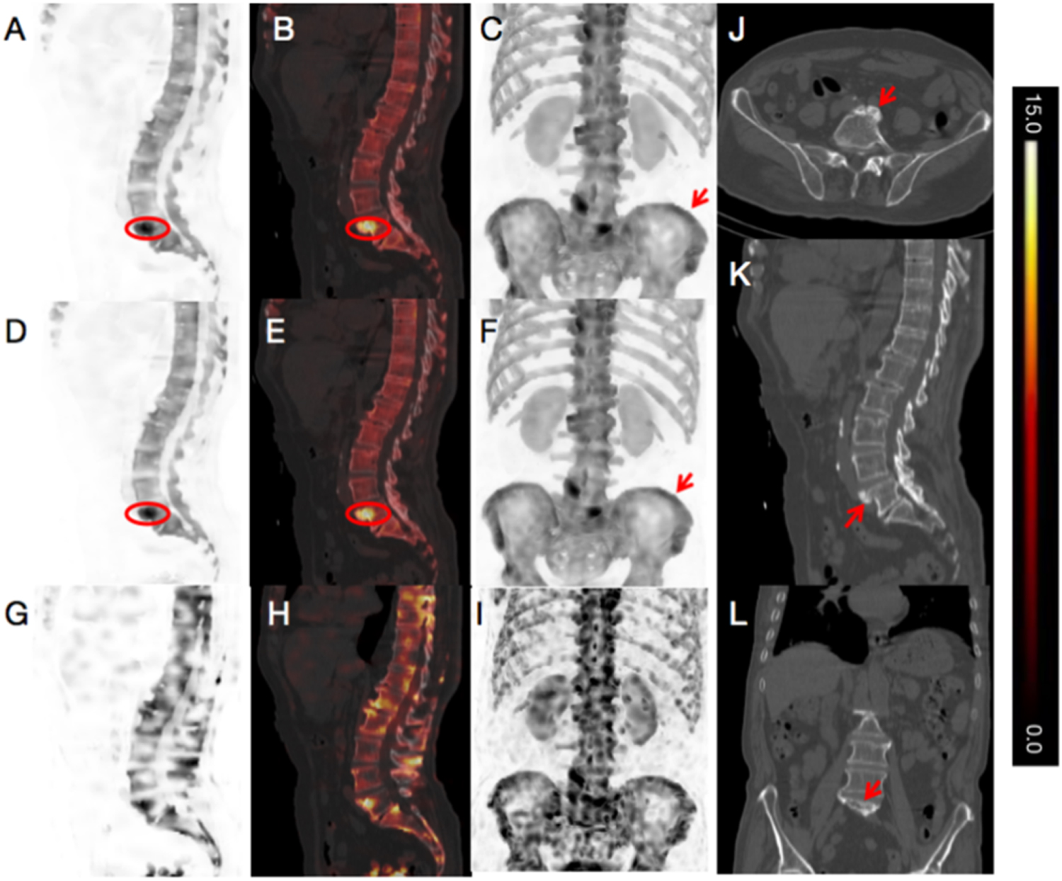 Deep learning enhanced ultra-fast SPECT/CT bone scan in patients with ...