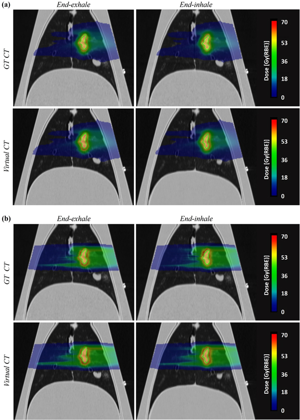 Virtual 4DCT generated from 4DMRI in gated particle therapy: phantom ...