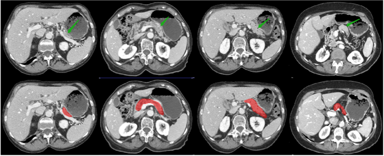 A two-stage data-model driven pancreas segmentation strategy embedding directional information ...