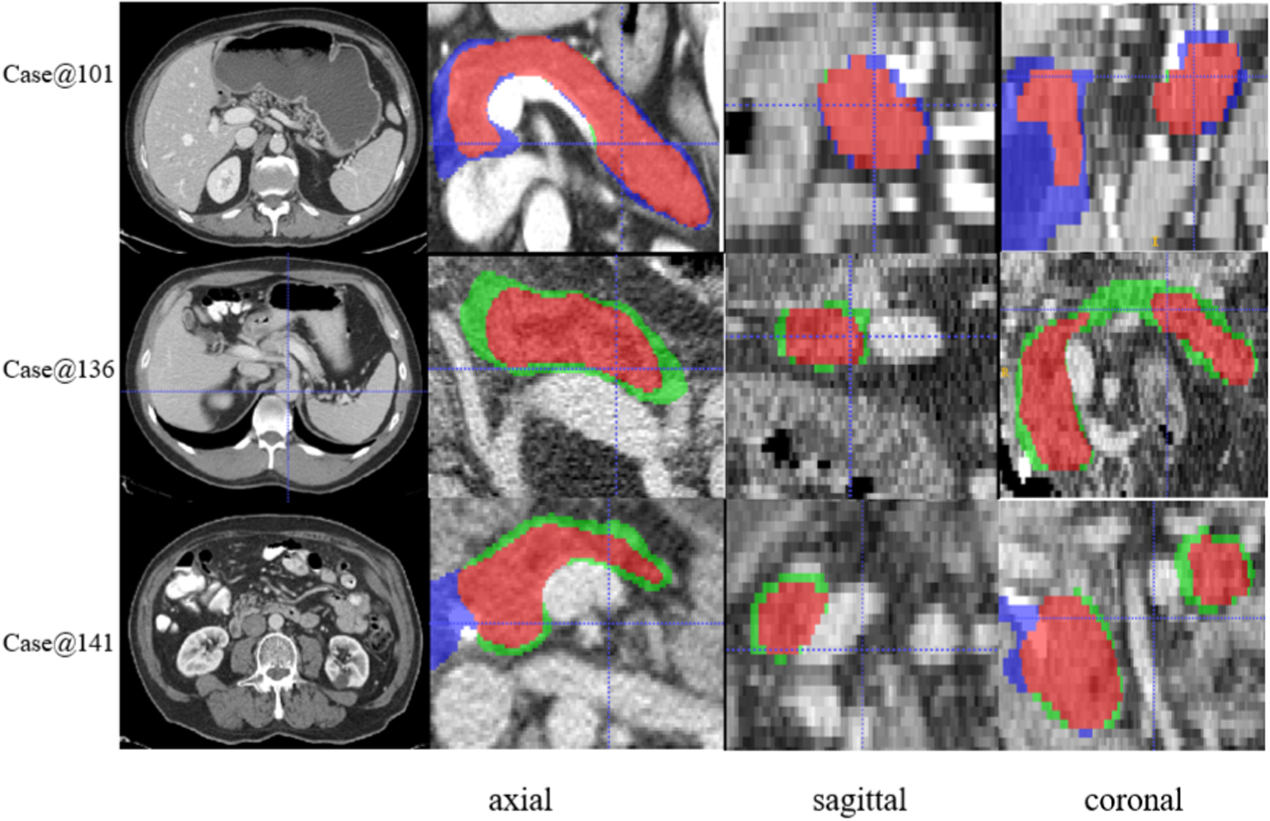 A two-stage data-model driven pancreas segmentation strategy embedding ...