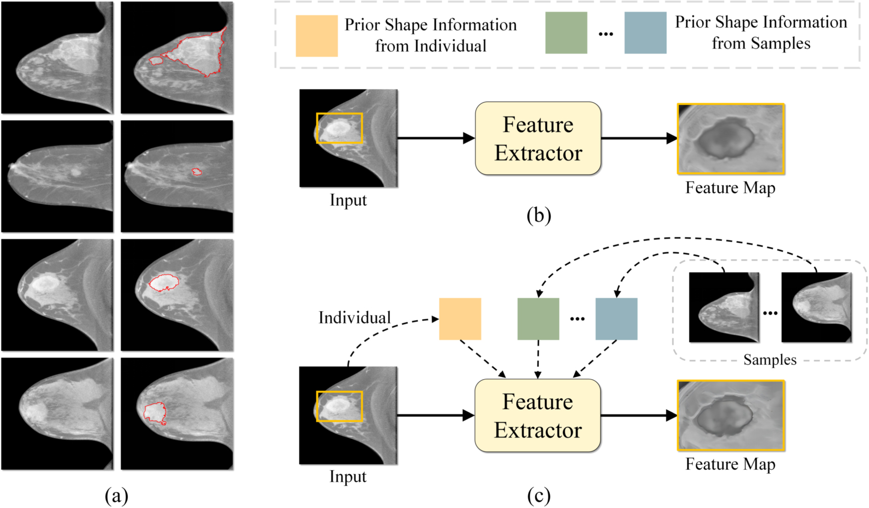 Improving breast tumor segmentation via shape-wise prior-guided ...