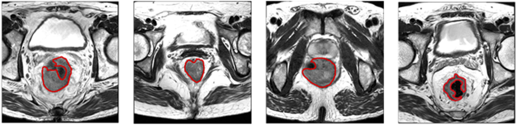 Automatic segmentation of rectal tumors from MRI using multiscale ...