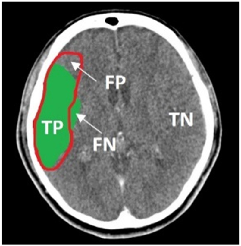Reduction of scan duration and radiation dose in cerebral CT perfusion ...
