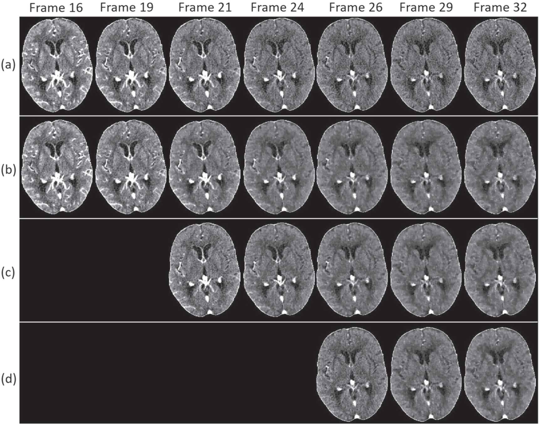 Reduction of scan duration and radiation dose in cerebral CT perfusion ...