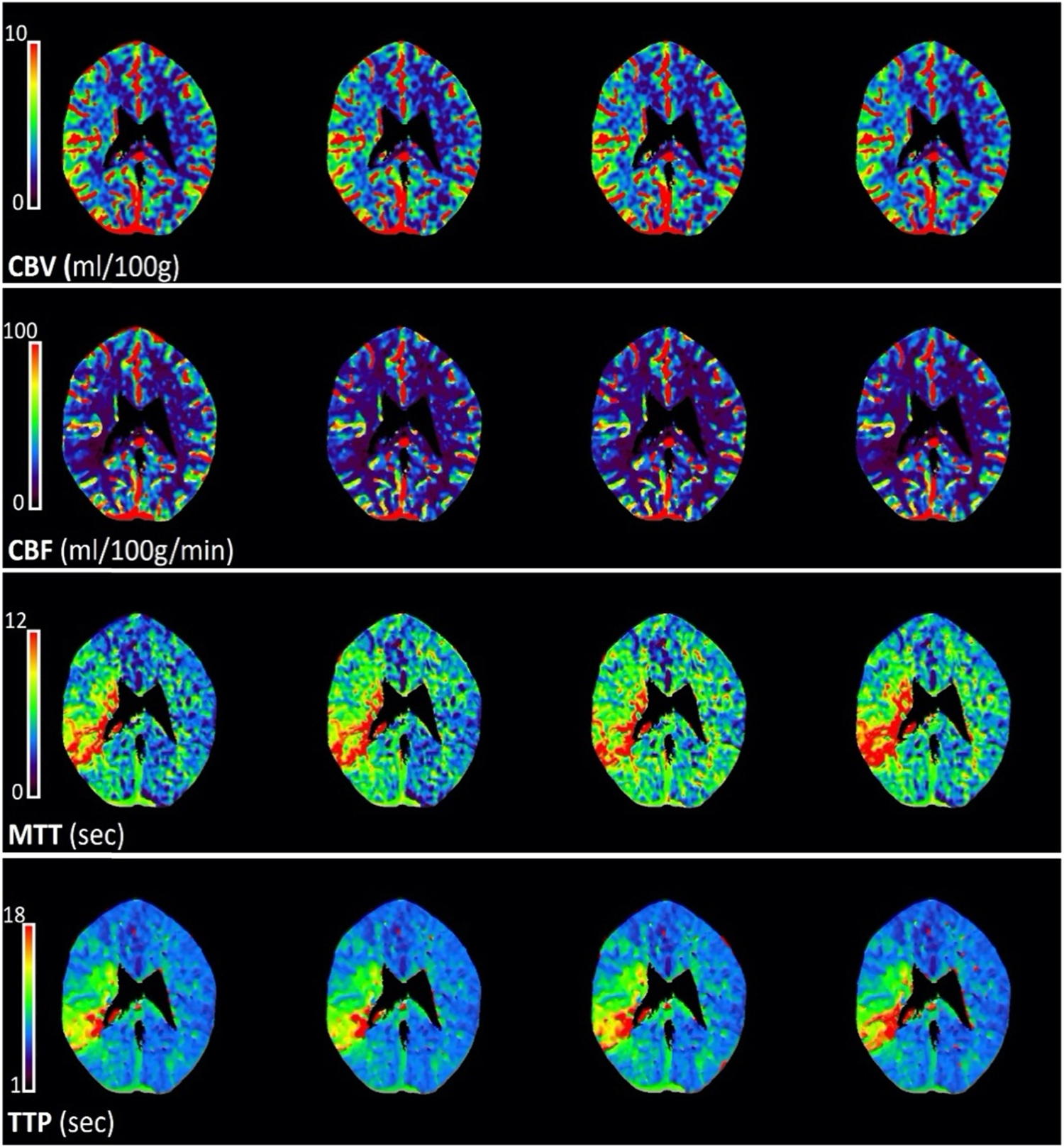 Reduction of scan duration and radiation dose in cerebral CT perfusion ...
