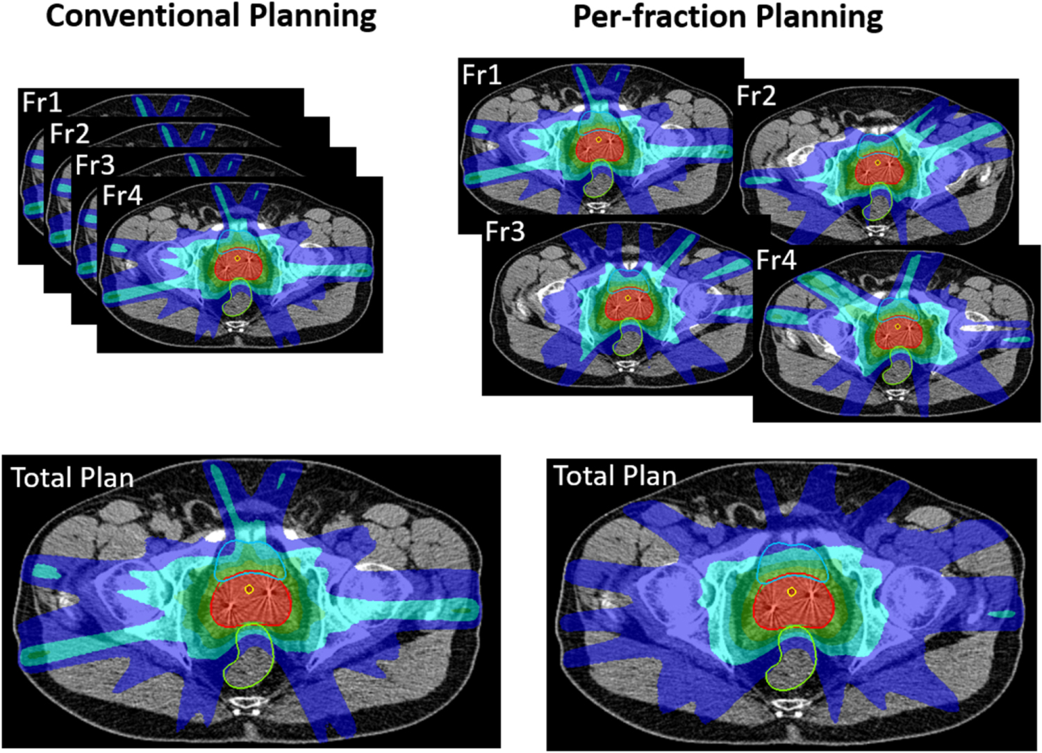Per-fraction planning to enhance optimization degrees of freedom ...