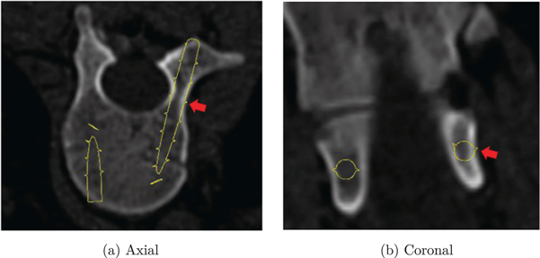 Improving pedicle screw path planning by vertebral posture estimation ...