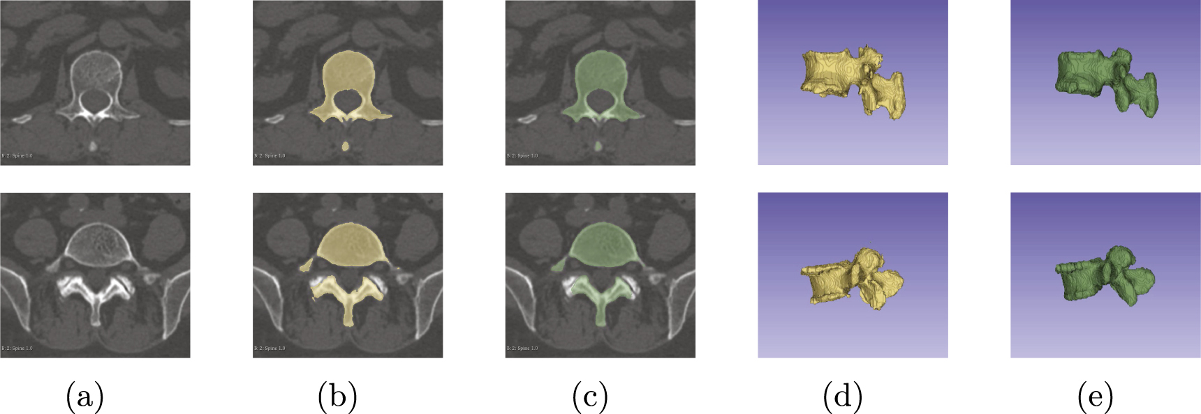 Improving pedicle screw path planning by vertebral posture estimation ...