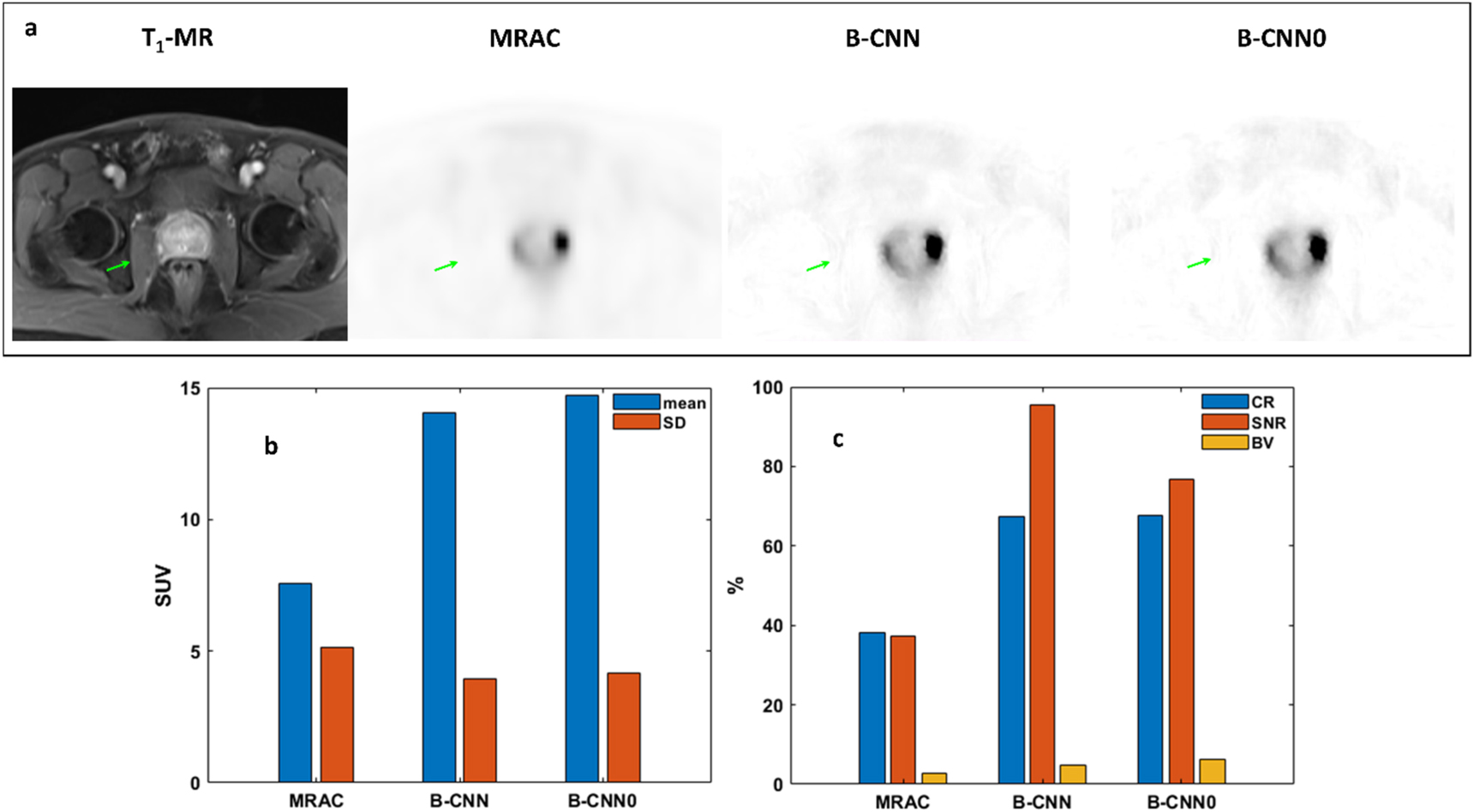 Evaluation of MR anatomically-guided PET reconstruction using a convolutional neural network in ...