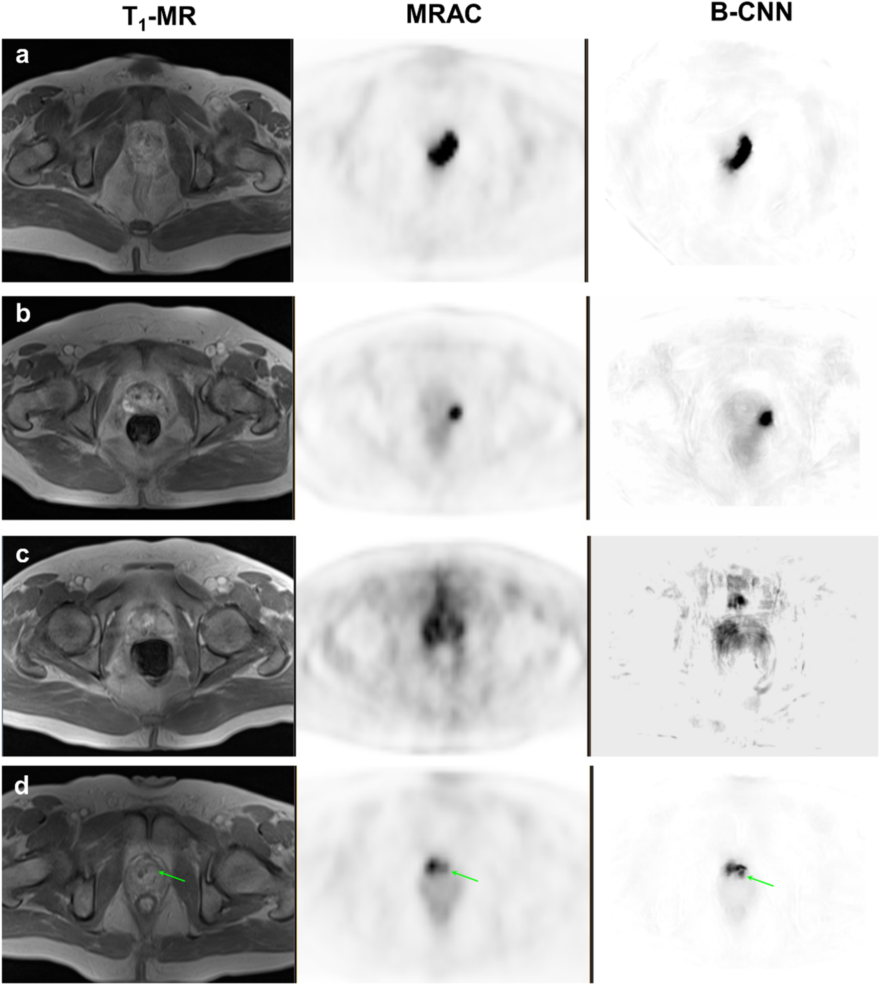 Evaluation of MR anatomically-guided PET reconstruction using a convolutional neural network in ...