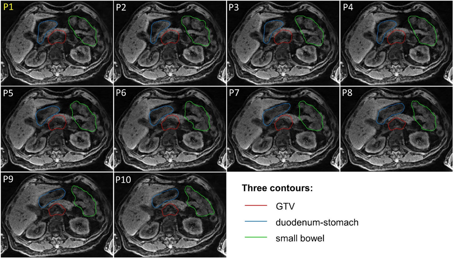 Real-time 4D MRI using MR signature matching (MRSIGMA) on a 1.5T MR ...