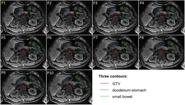 Real-time 4D MRI using MR signature matching (MRSIGMA) on a 1.5T MR-Linac system - IOPscience