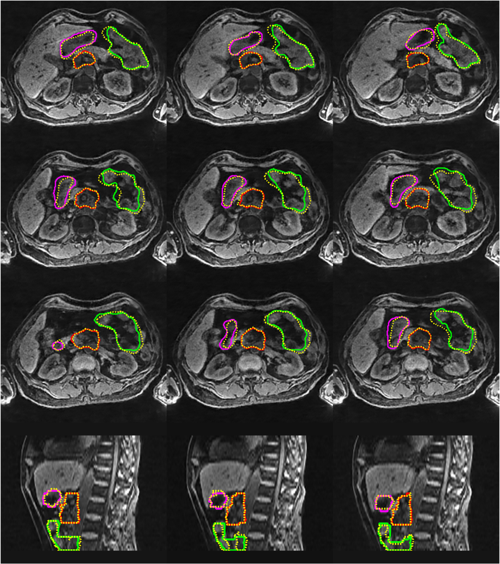 Real-time 4D MRI using MR signature matching (MRSIGMA) on a 1.5T MR ...