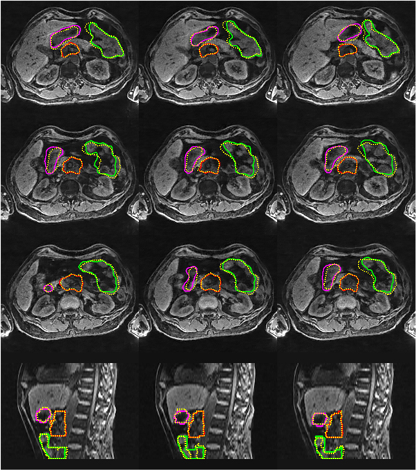 Real-time 4D MRI using MR signature matching (MRSIGMA) on a 1.5T MR-Linac system - IOPscience