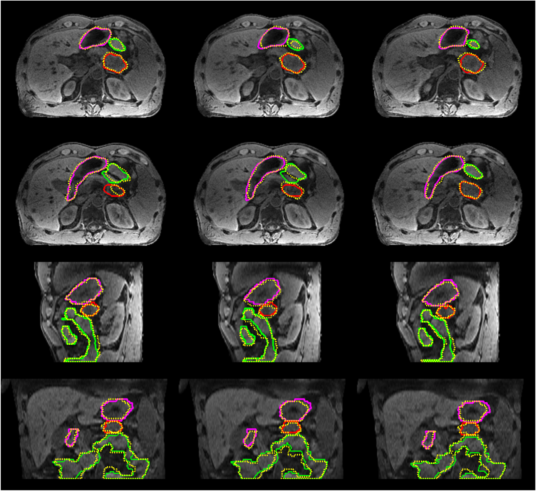Real-time 4D MRI using MR signature matching (MRSIGMA) on a 1.5T MR-Linac system - IOPscience