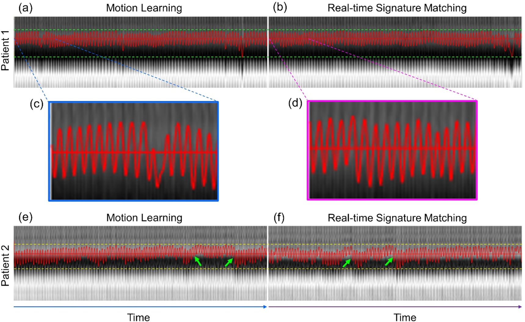 Real-time 4D MRI using MR signature matching (MRSIGMA) on a 1.5T MR ...