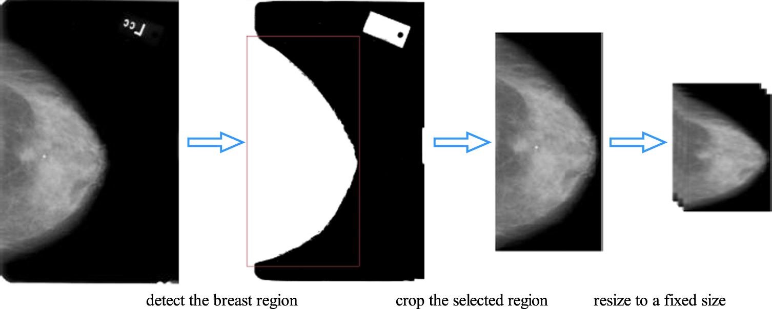 FSE-Net: feature selection and enhancement network for mammogram classification - IOPscience