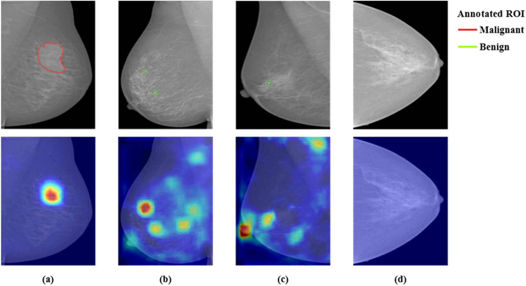 FSE-Net: feature selection and enhancement network for mammogram classification - IOPscience