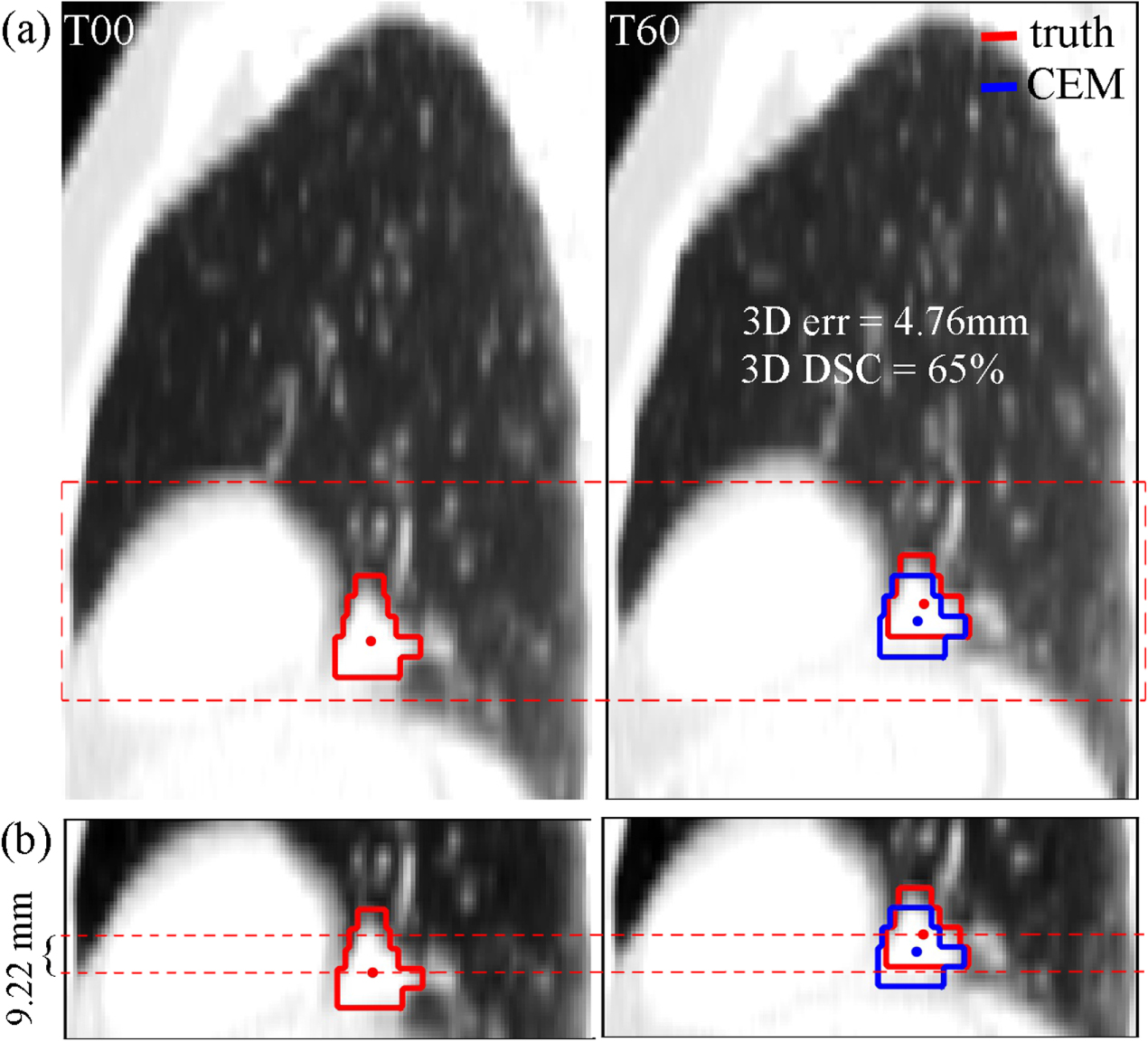 Extracting lung contour deformation features with deep learning for ...