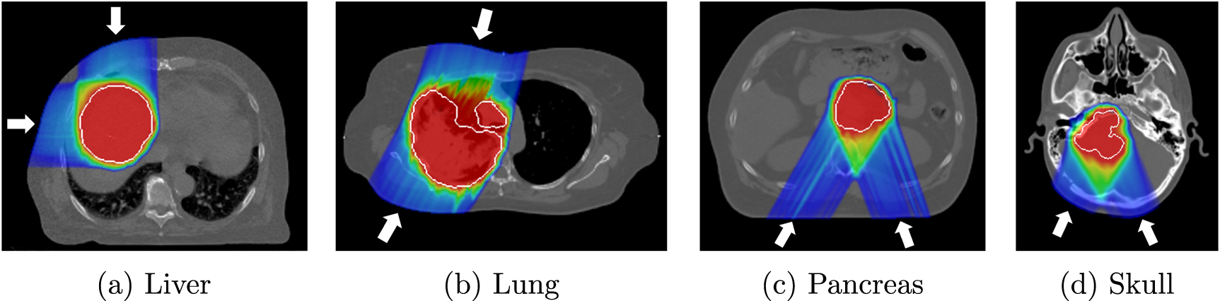 A fast analytical dose calculation approach for MRI-guided proton ...