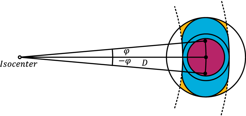 Innovative margin design and optimized isocenter to minimize the normal ...