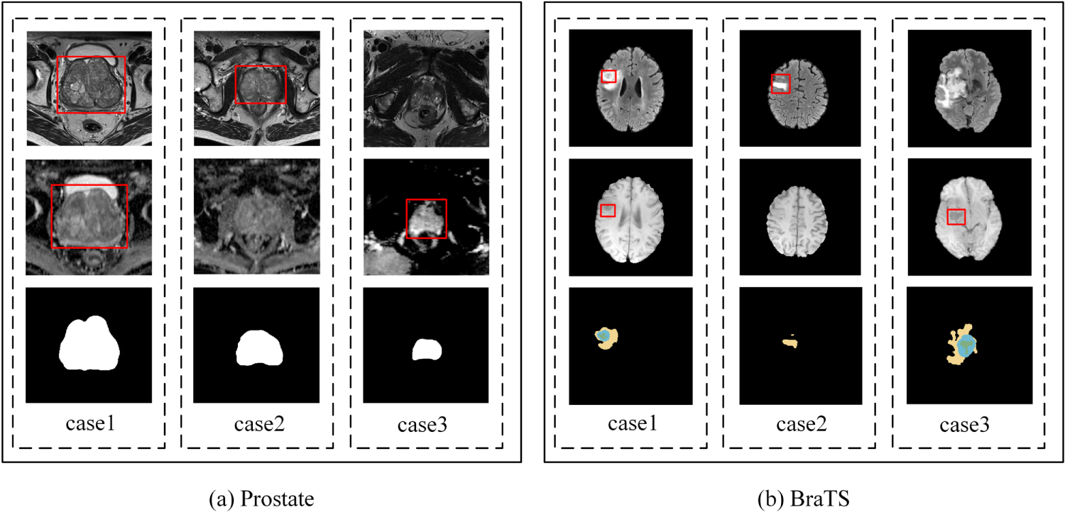 Automated multi-modal Transformer network (AMTNet) for 3D medical images segmentation - IOPscience