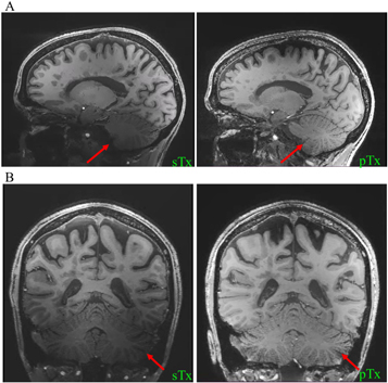 Ultra-high field MRI: parallel-transmit arrays and RF pulse design ...