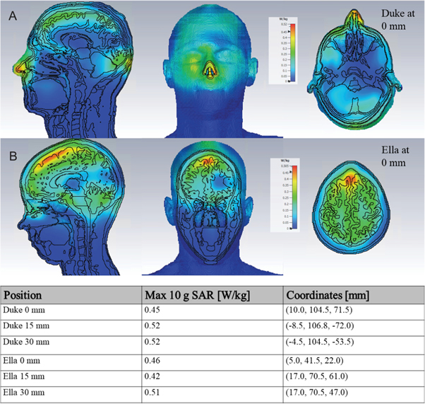 Ultra-high field MRI: parallel-transmit arrays and RF pulse design ...