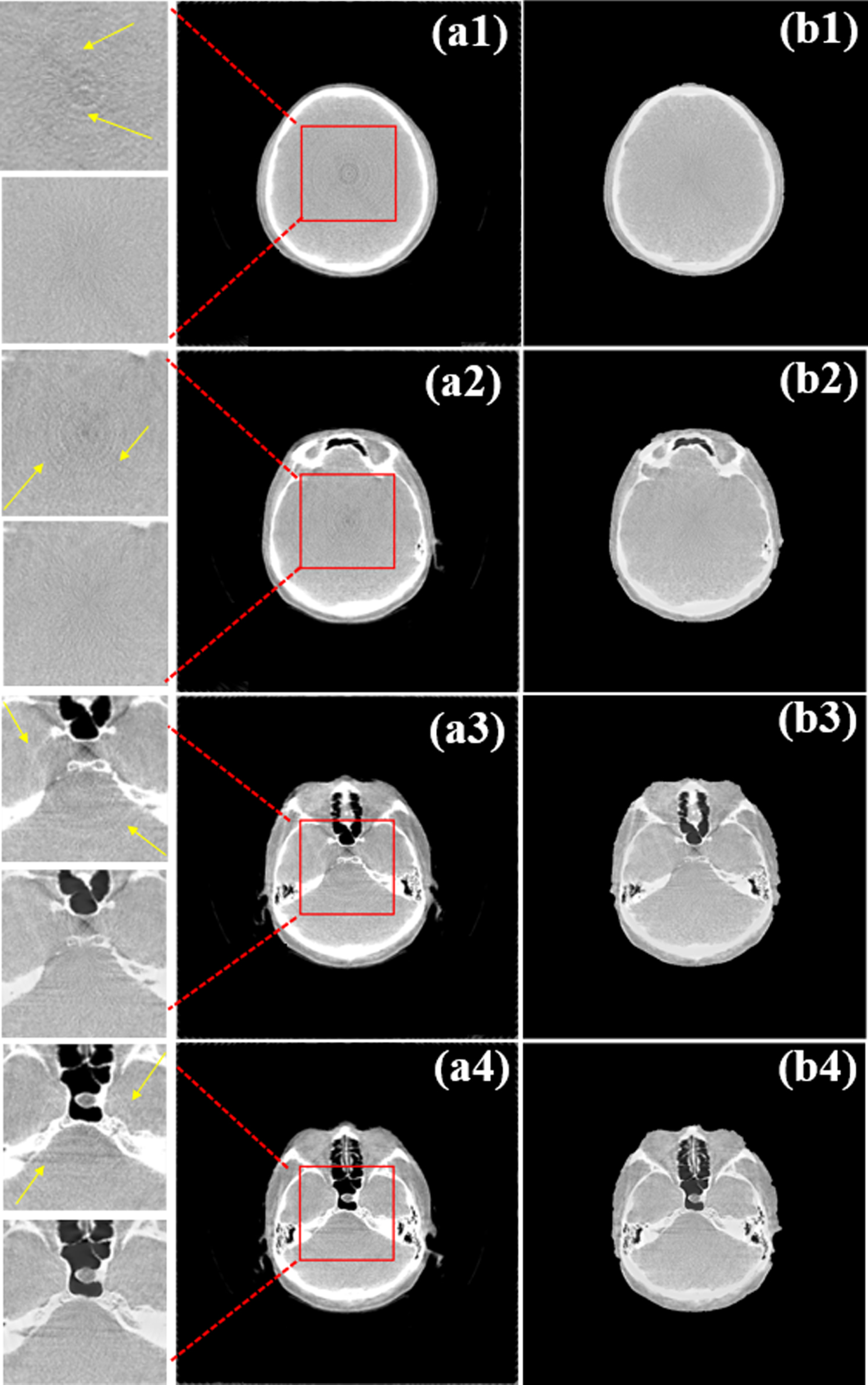 Ring artifacts correction for computed tomography image using ...