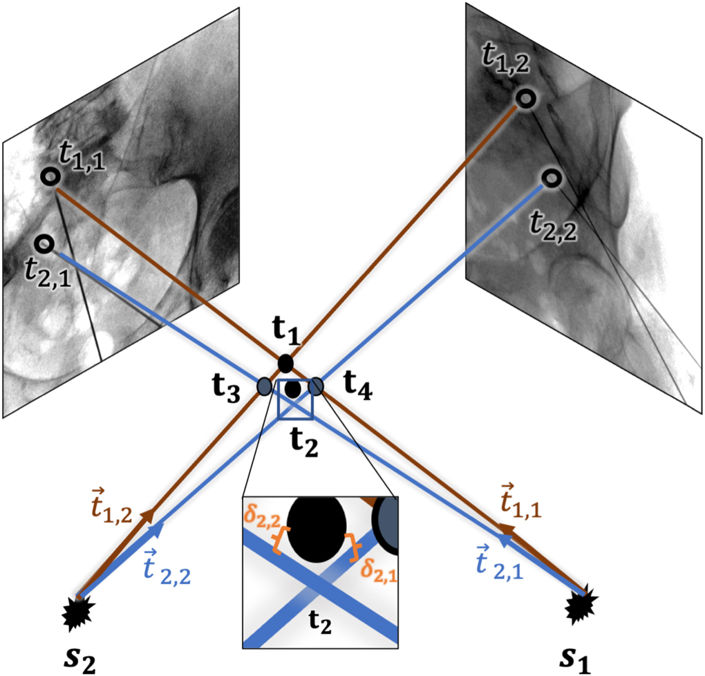 Surgical navigation for guidewire placement from intraoperative ...