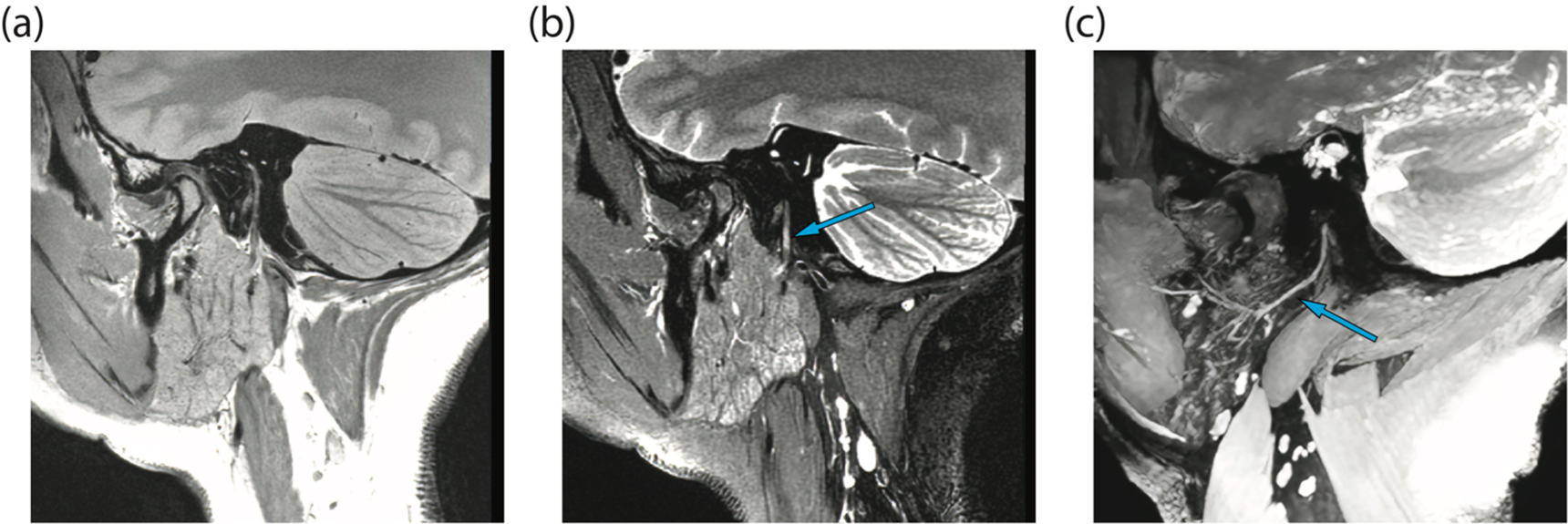 Flexible array coil for cervical and extraspinal (FACE) MRI at 3.0 ...