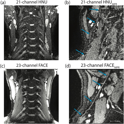 Flexible array coil for cervical and extraspinal (FACE) MRI at 3.0 ...