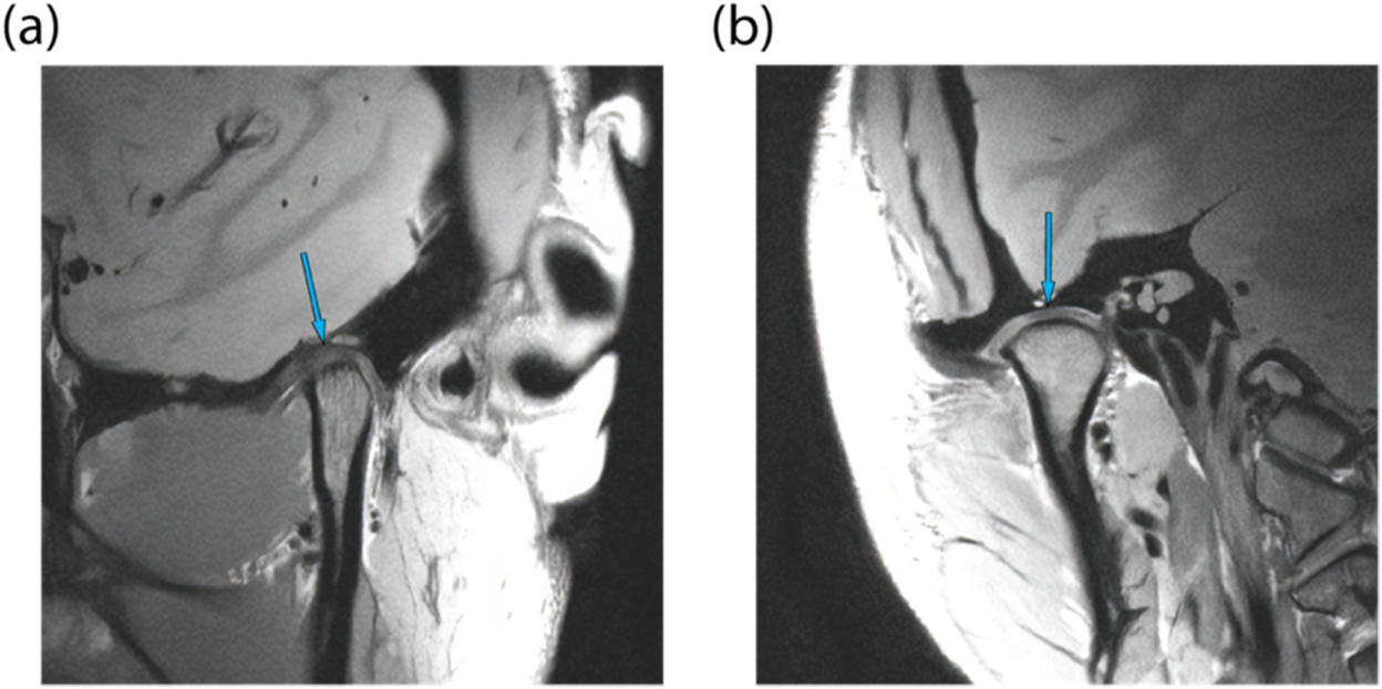 Flexible array coil for cervical and extraspinal (FACE) MRI at 3.0 ...