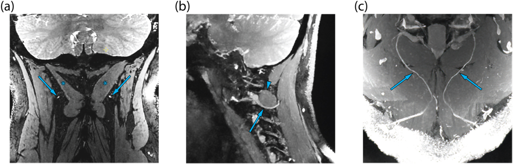 Flexible array coil for cervical and extraspinal (FACE) MRI at 3.0 ...