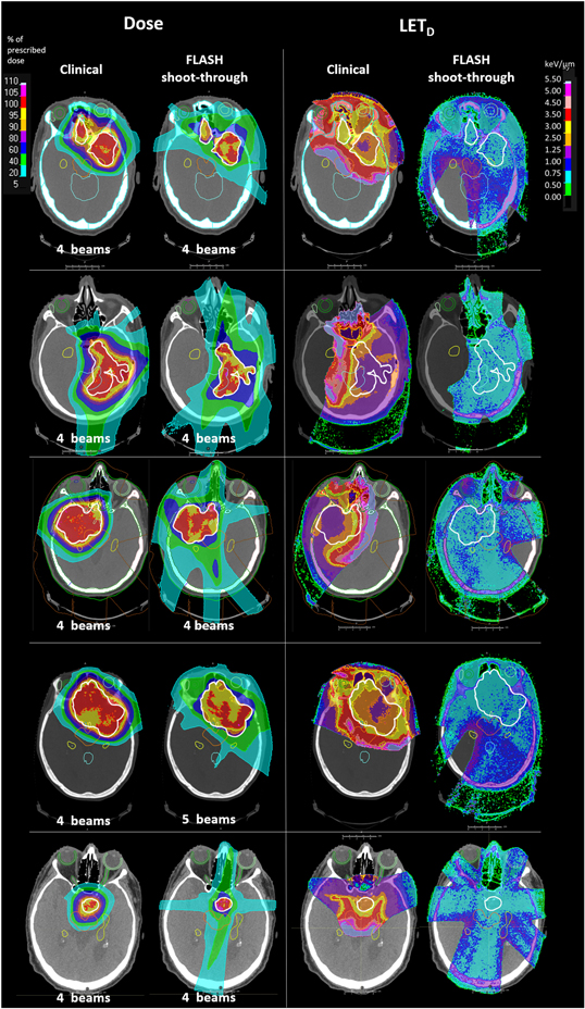 Shoot-through proton FLASH irradiation lowers linear energy transfer in ...