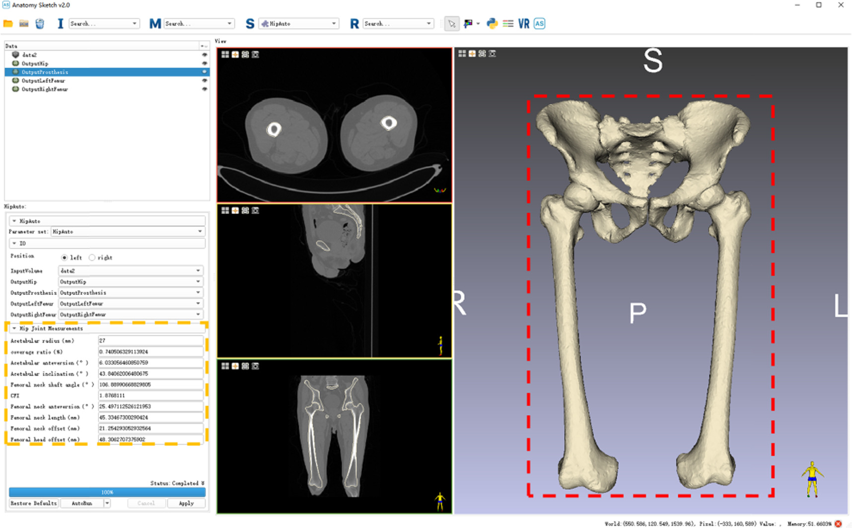Deep learning-based workflow for hip joint morphometric parameter ...