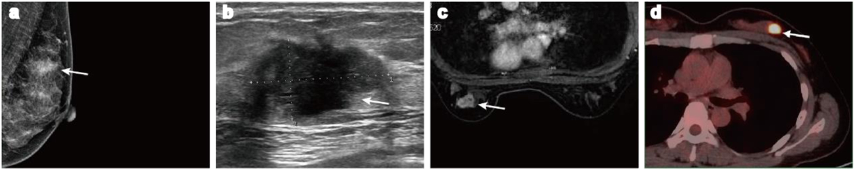 Artificial intelligence in breast imaging: potentials and challenges ...