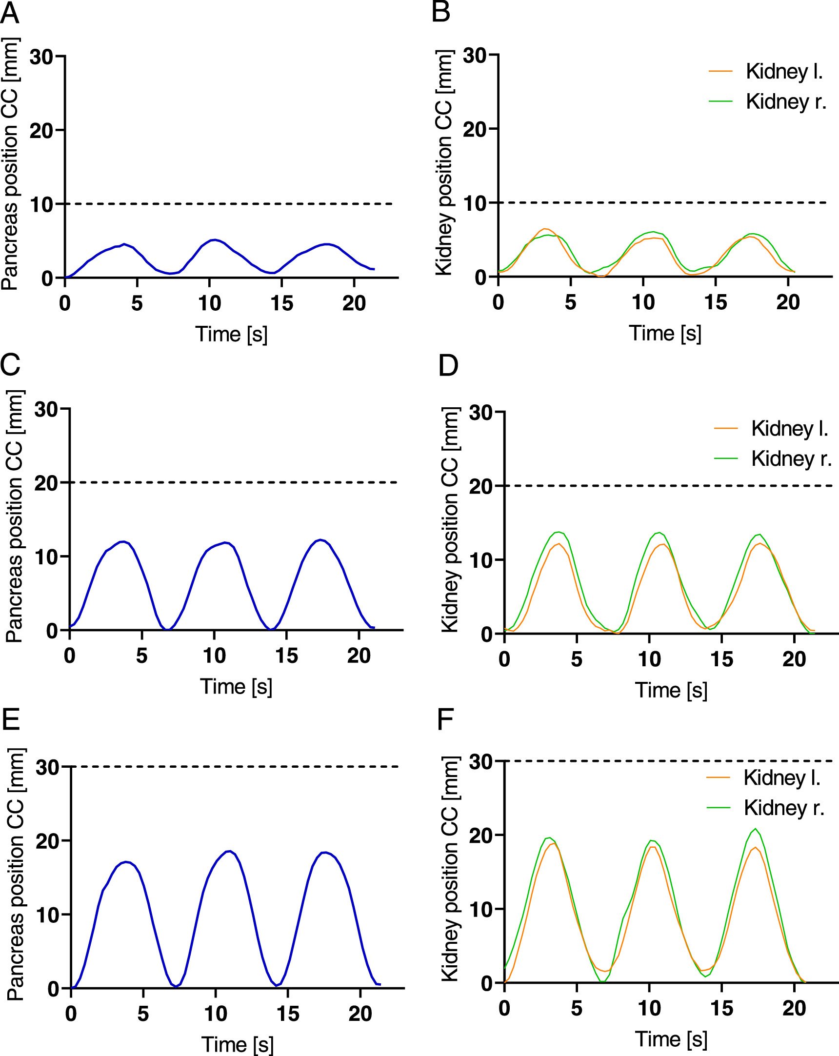 A phantom to simulate organ motion and its effect on dose distribution ...