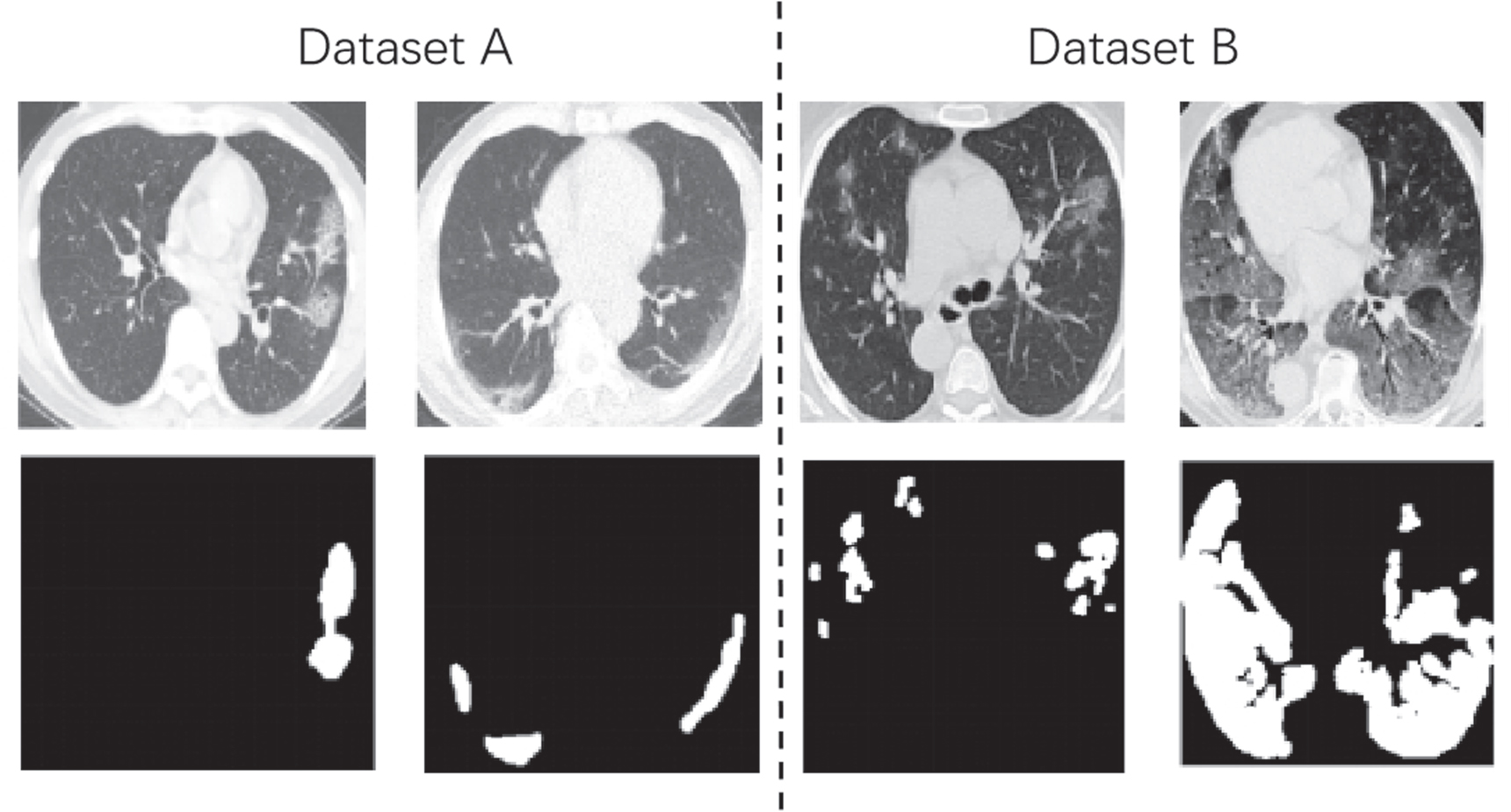 BPCN: bilateral progressive compensation network for lung infection ...