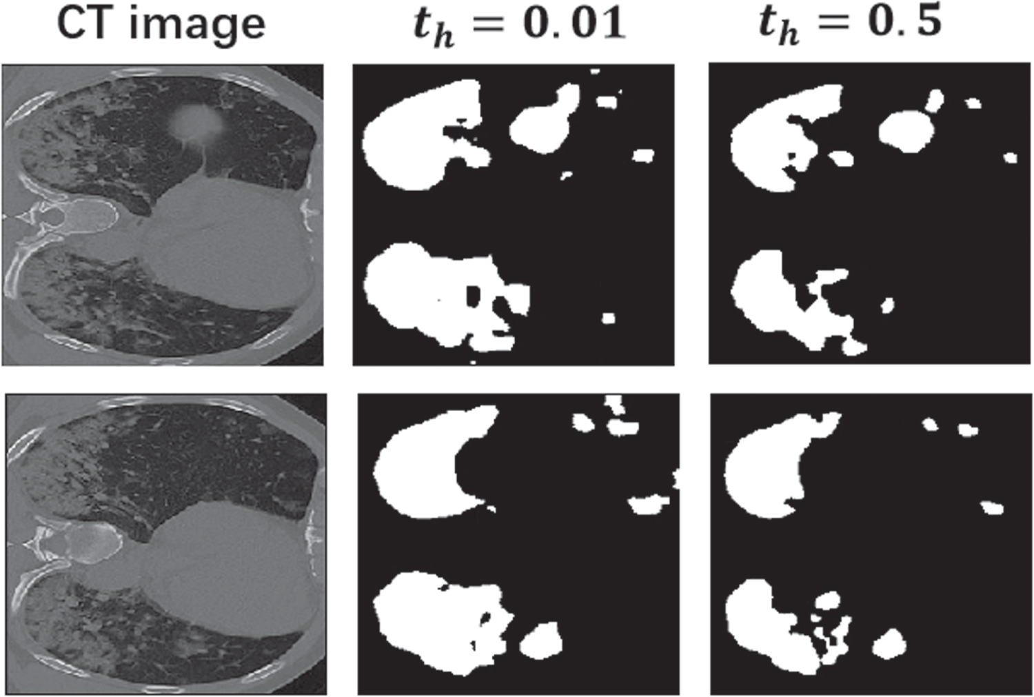 BPCN: bilateral progressive compensation network for lung infection ...
