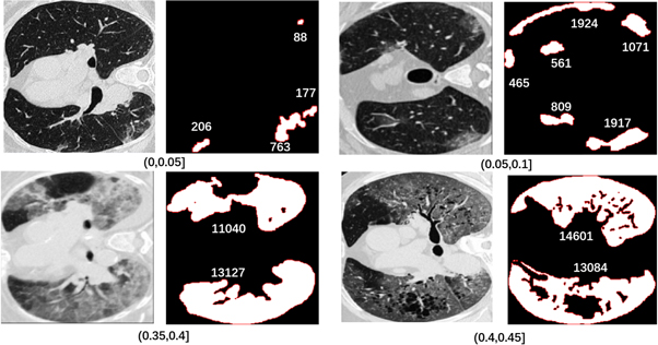BPCN: bilateral progressive compensation network for lung infection ...