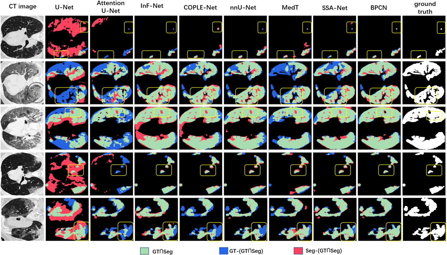BPCN: bilateral progressive compensation network for lung infection ...