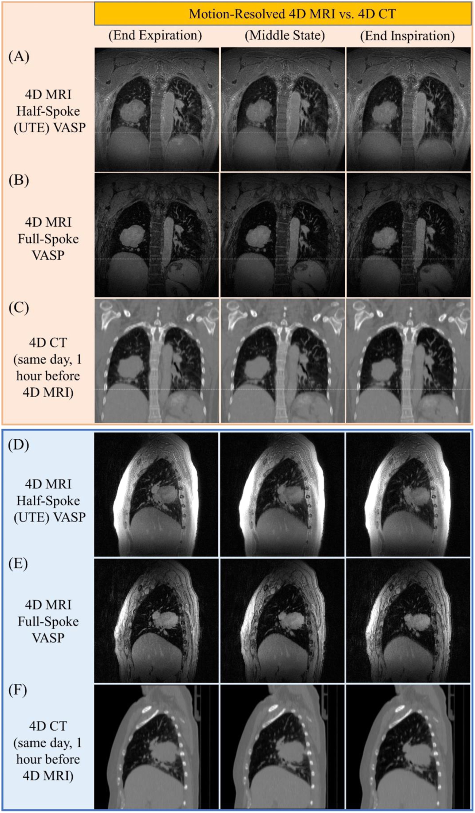 4D lung MRI with high-isotropic-resolution using half-spoke (UTE) and ...