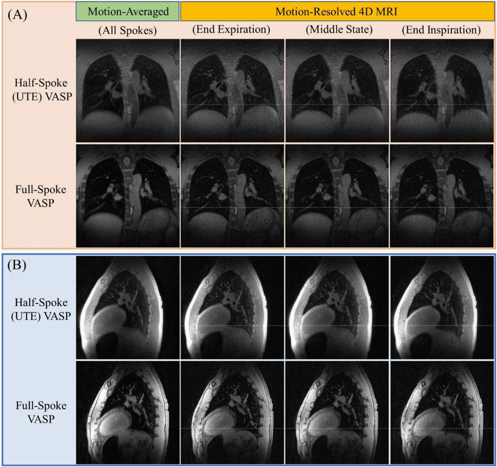 4D lung MRI with high-isotropic-resolution using half-spoke (UTE) and ...