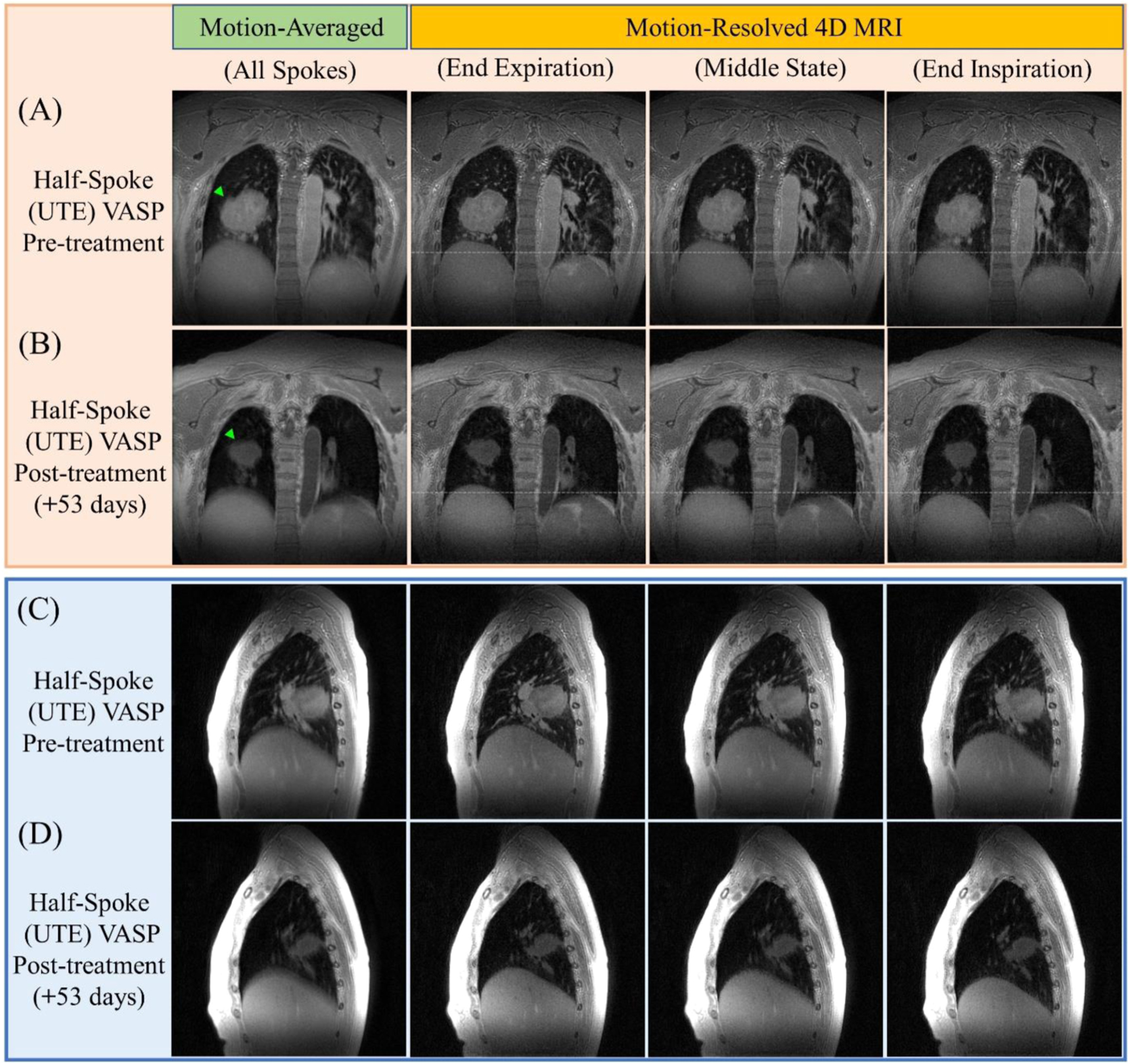 4D lung MRI with high-isotropic-resolution using half-spoke (UTE) and ...