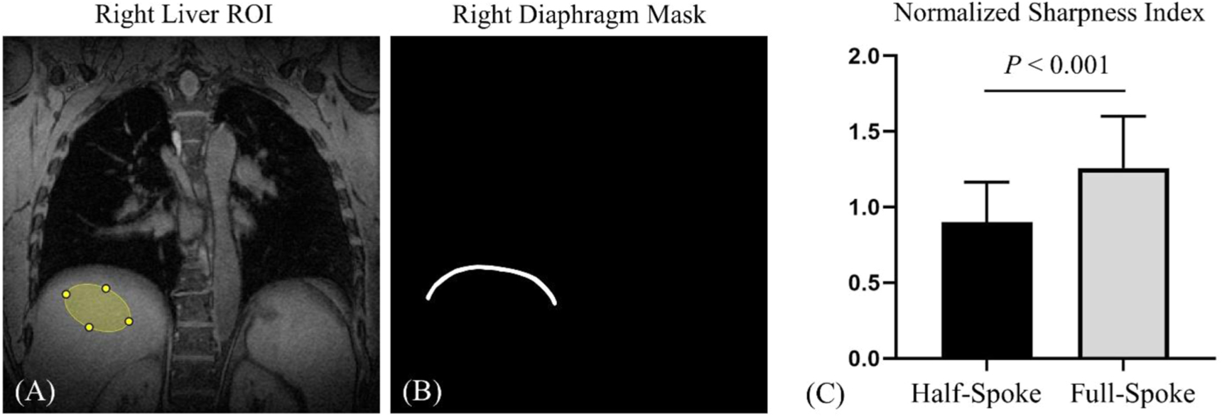 4D lung MRI with high-isotropic-resolution using half-spoke (UTE) and ...
