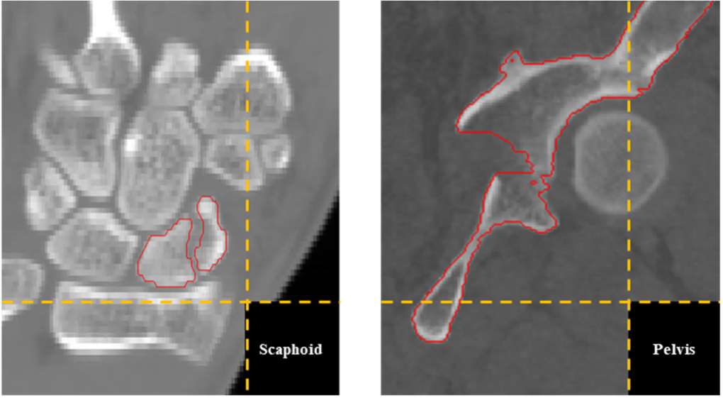 Pairwise attention-enhanced adversarial model for automatic bone ...