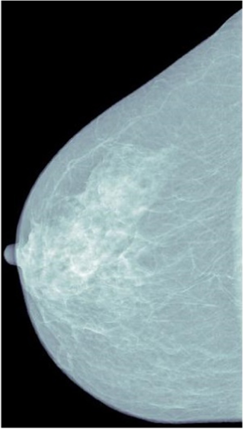 A nonparametric measure of noise in x-ray diagnostic images—mammography ...