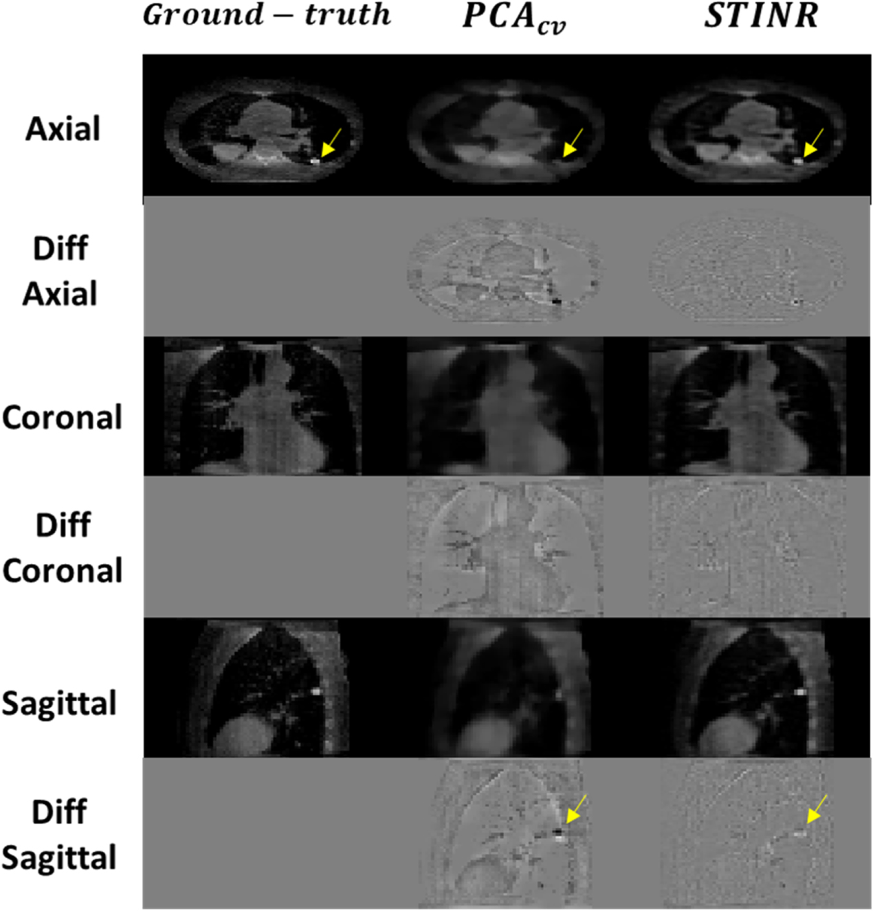 Dynamic cone-beam CT reconstruction using spatial and temporal implicit neural representation ...